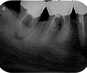 Was zeigt das DVT ? (5) – Zahn 46 und 47 vor WF – Revision | WURZELSPITZE