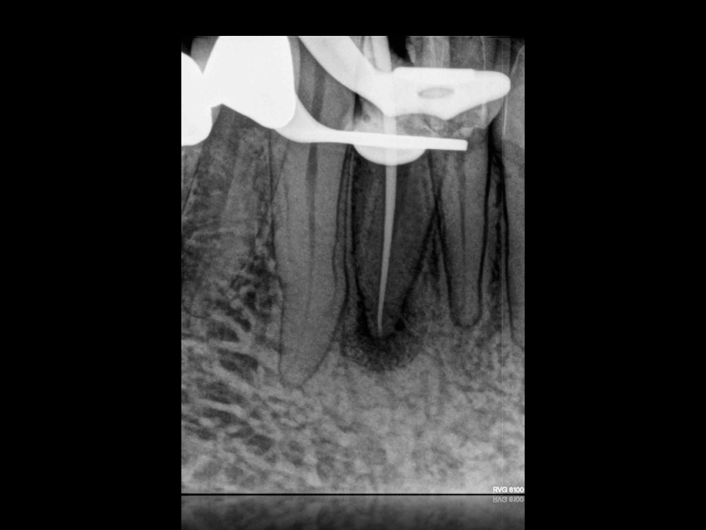 Instrumentenentfernung bei einem UK-Frontzahn (II) | WURZELSPITZE