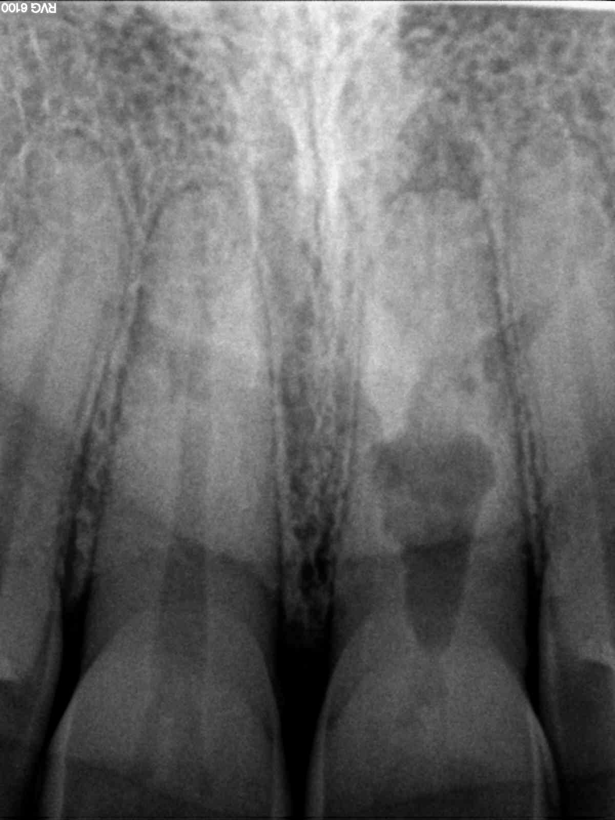 Wie eine Pulpanekrose einen Zahn retten kann. | WURZELSPITZE
