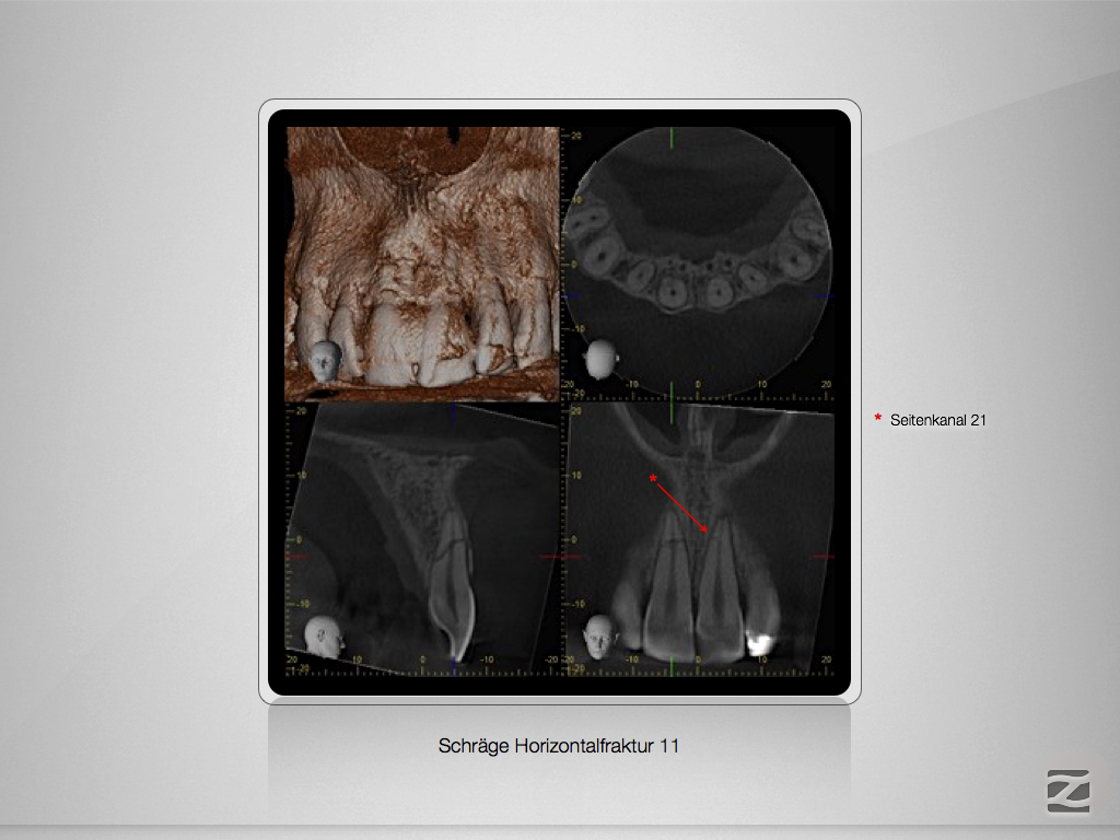 Die Tücke der Endometrie … | WURZELSPITZE