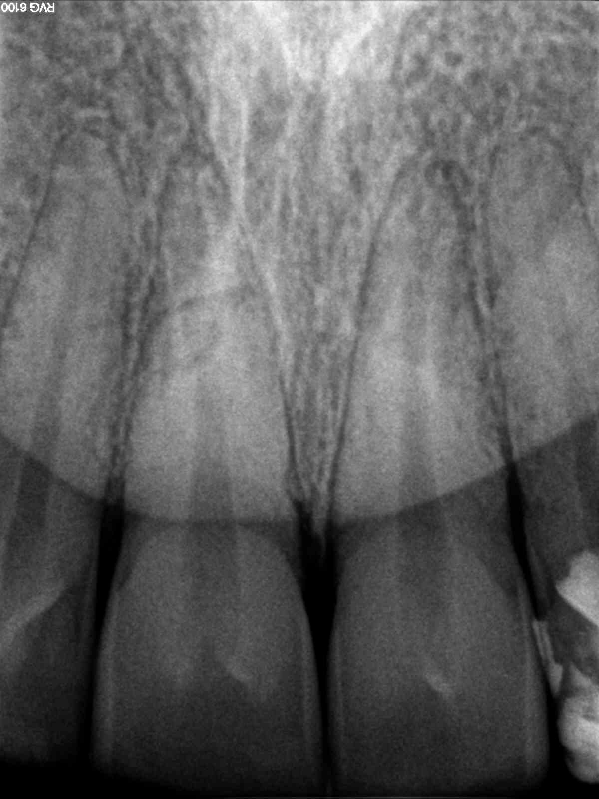 Die Tücke der Endometrie … | WURZELSPITZE