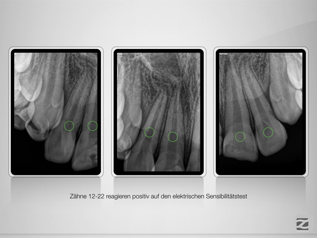 Frontzahntrauma – das klinische Vorgehen. | WURZELSPITZE