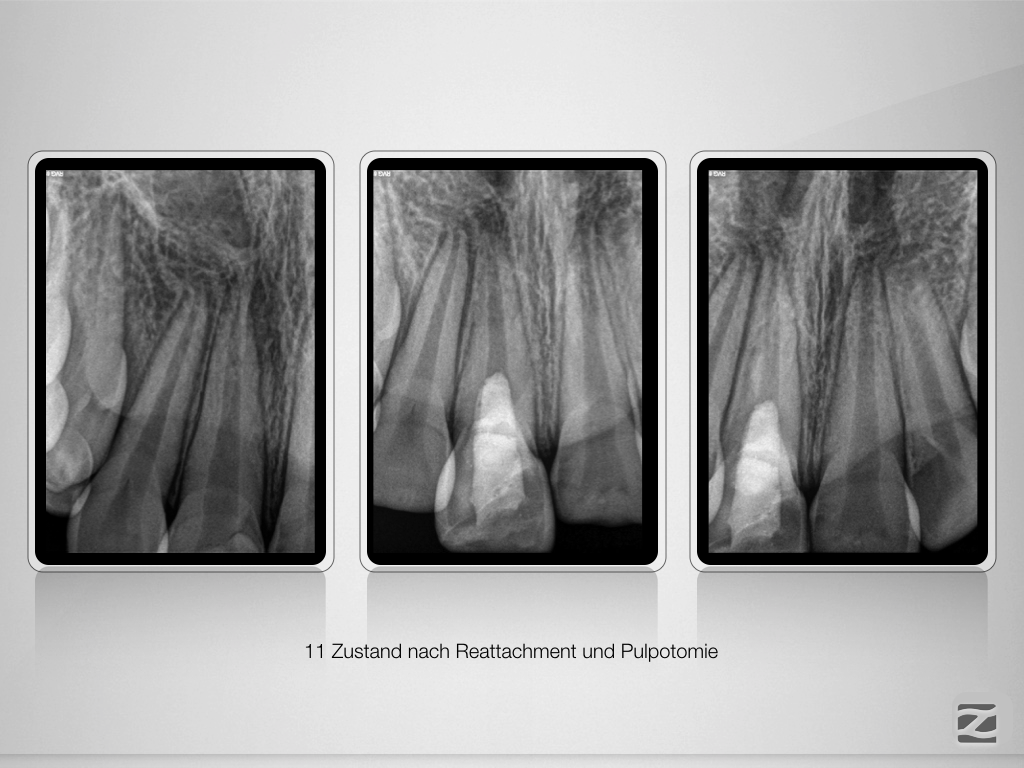 Frontzahntrauma – das klinische Vorgehen. | WURZELSPITZE