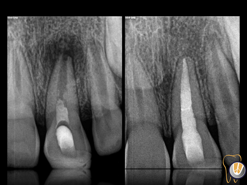 Kurz berichtet – Apikale Aufhellung – ausgeheilt nach Trauma – reloaded ...