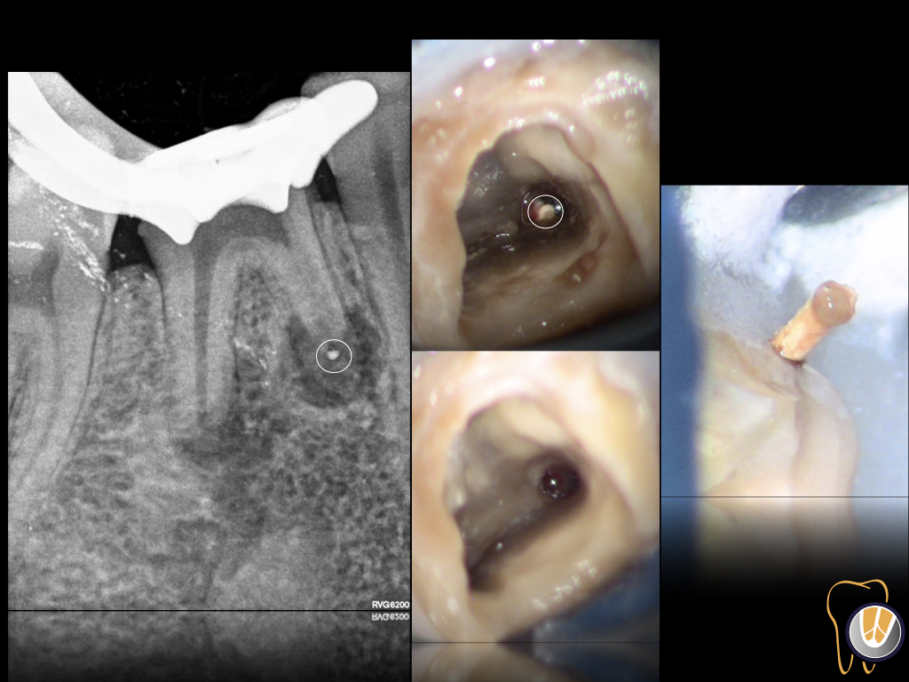 Herodontics Zahn 46 (I) | WURZELSPITZE