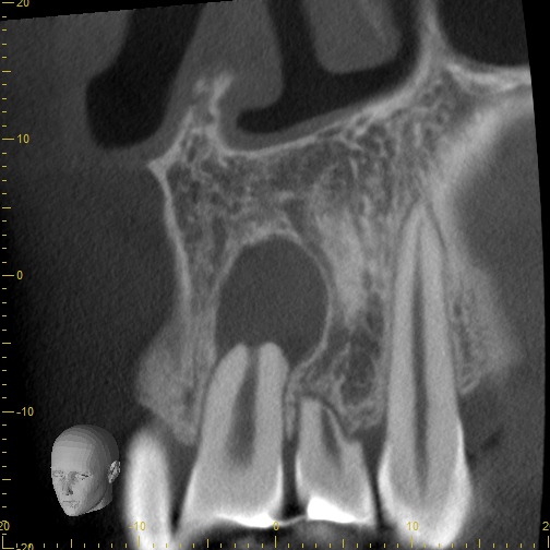 Zahn 21, weit offener Apex, große apikale Aufhellung | WURZELSPITZE