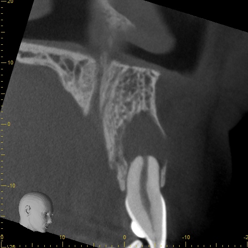 Zahn 21, weit offener Apex, große apikale Aufhellung | WURZELSPITZE