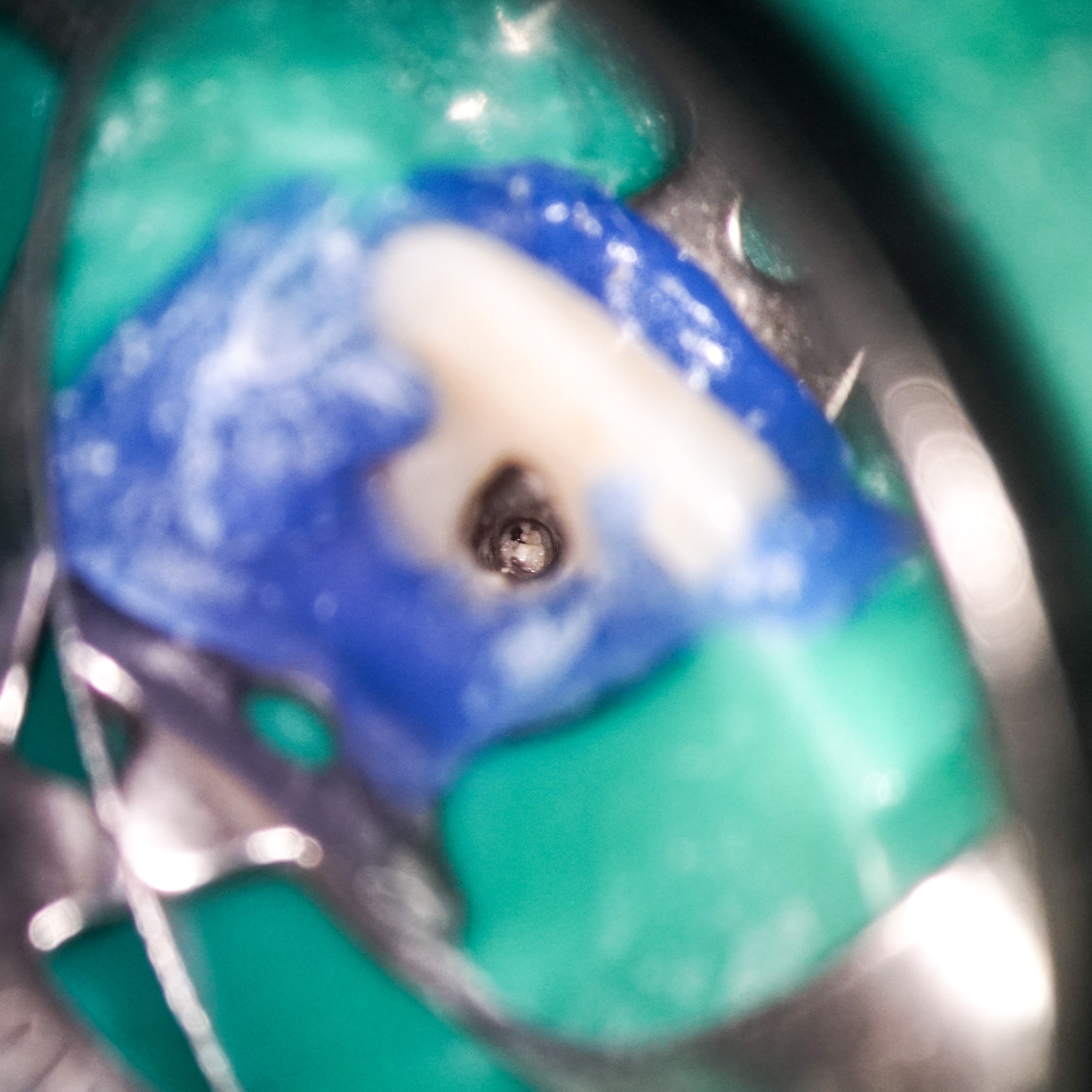 Zahn 21, weit offener Apex, große apikale Aufhellung | WURZELSPITZE