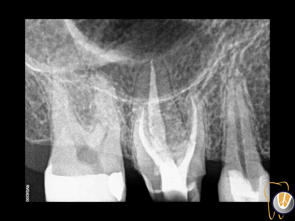 Total Fill BC Sealer high flow (I) | WURZELSPITZE