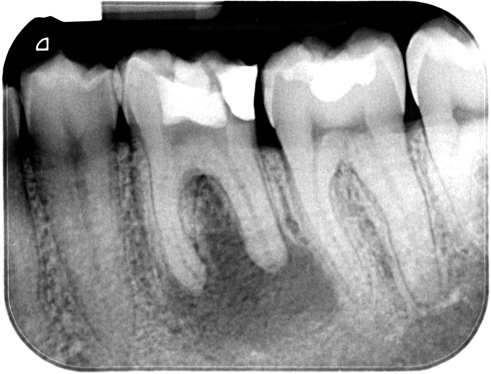 Recall 7 Monate nach WF Zahn 36 – ausgedehnte apikale Aufhellung ...