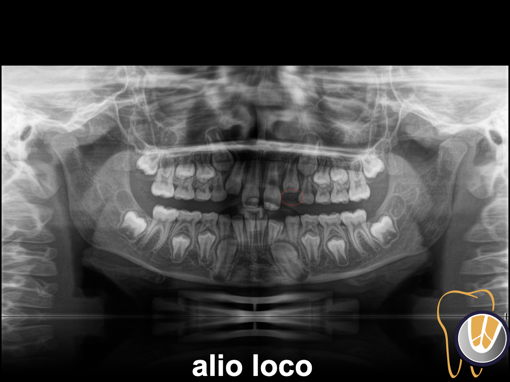 Fistel unklarer Genese (I) | WURZELSPITZE