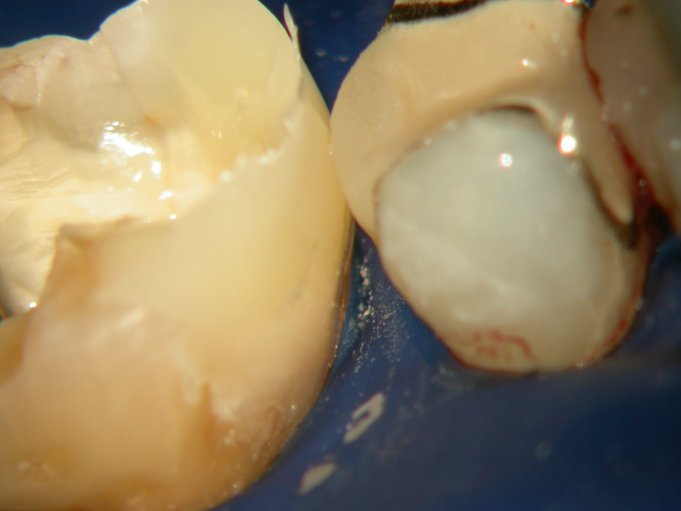 Präendodontischer Aufbau | WURZELSPITZE