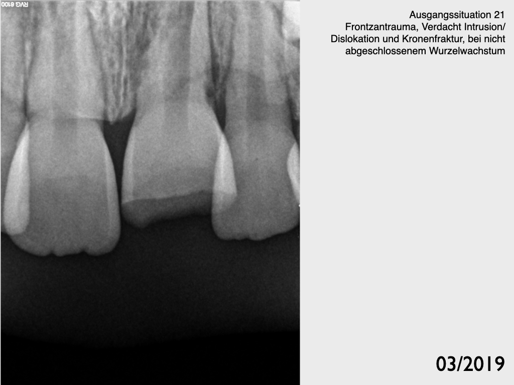 Z.n. Frontzahntrauma – Reparative endodontische Therapie | WURZELSPITZE
