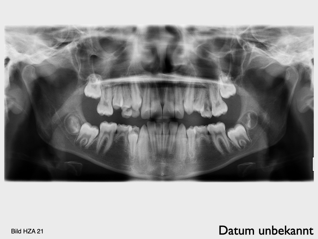 Persistierende Fistel | WURZELSPITZE