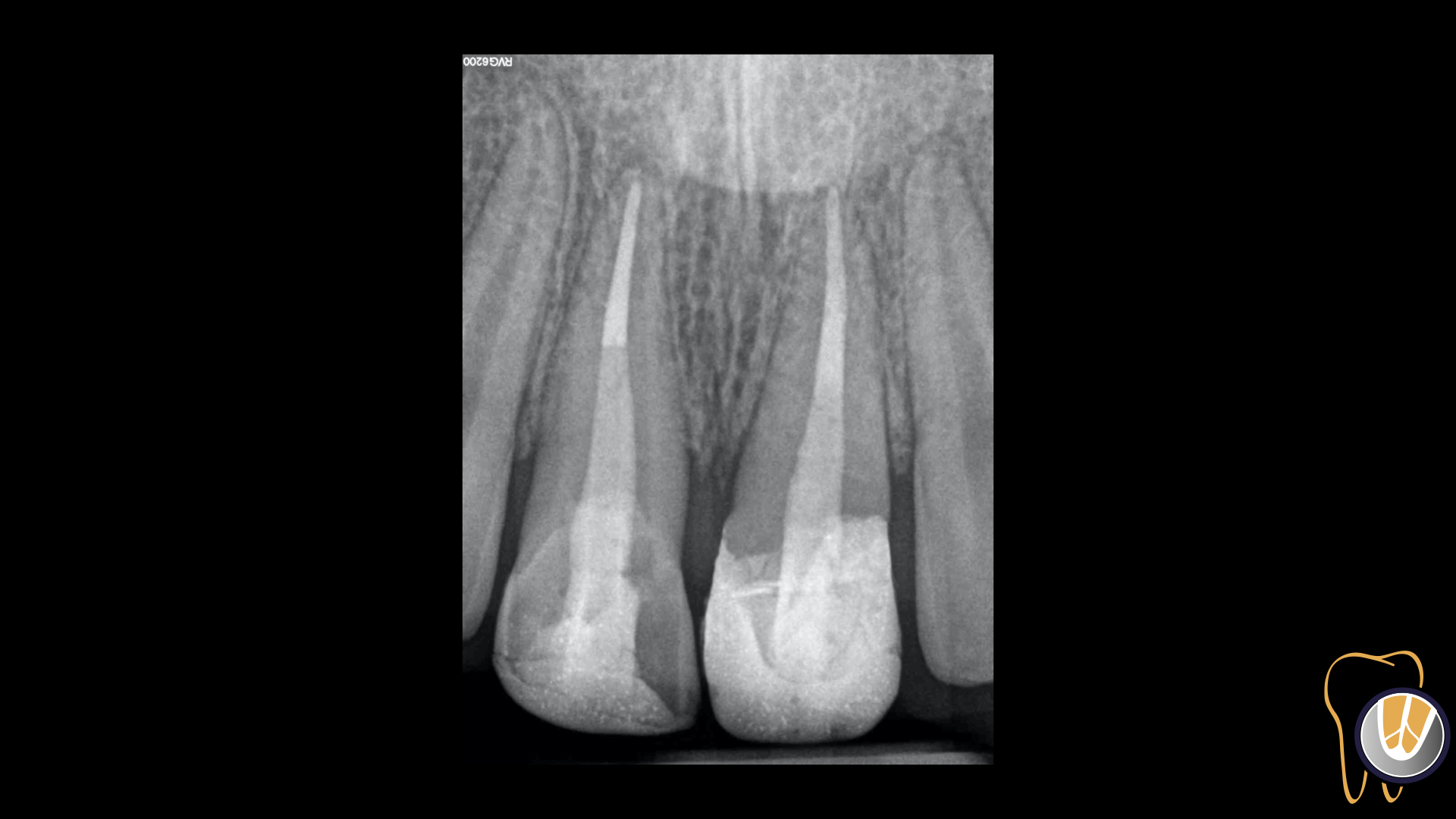 Zahntrauma mit komplizierten Kronen-Wurzelfrakturen (IV) | WURZELSPITZE