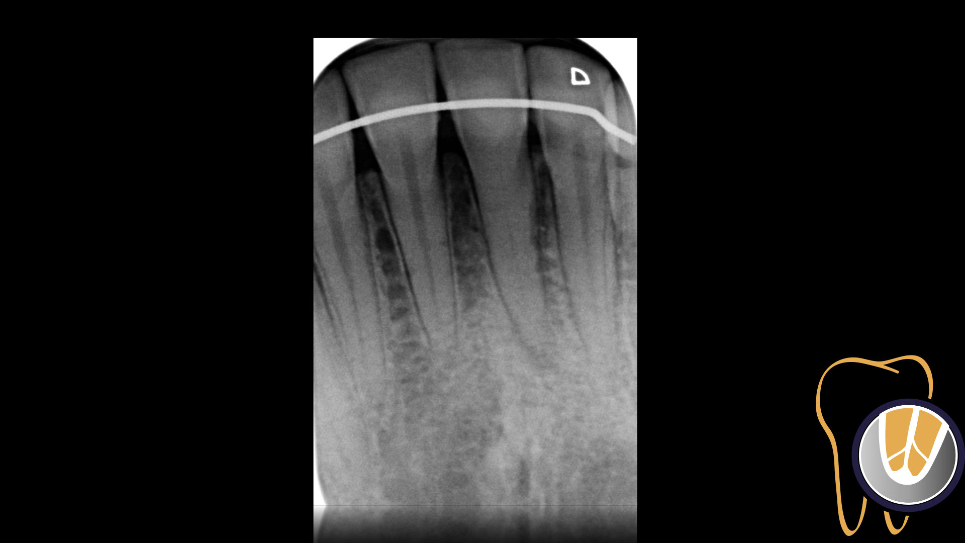 Misserfolg – Unterkiefer Frontzahn | WURZELSPITZE