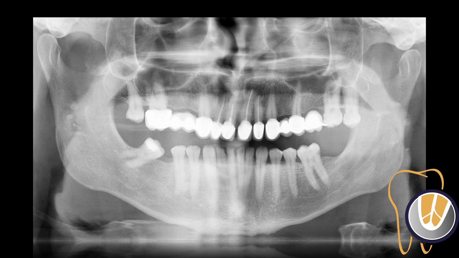 Revision dreier Oberkiefer-Frontzähne inkl. Lentuloentfernung ...
